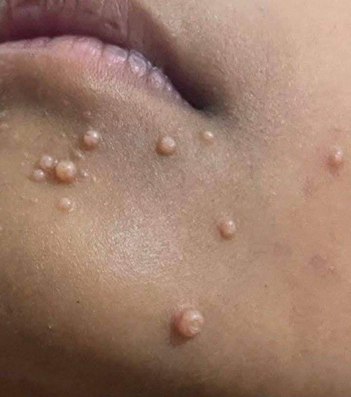 Guía básica sobre el molusco contagioso: una infección cutánea común ...